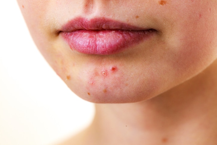 What your acne is trying to tell you about your health | Watsons Thailand