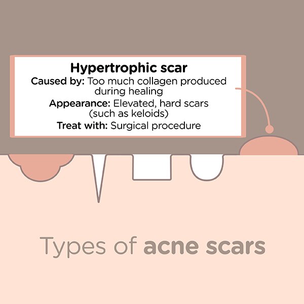 Types of Acne Scar | Watsons Thailand | Blog